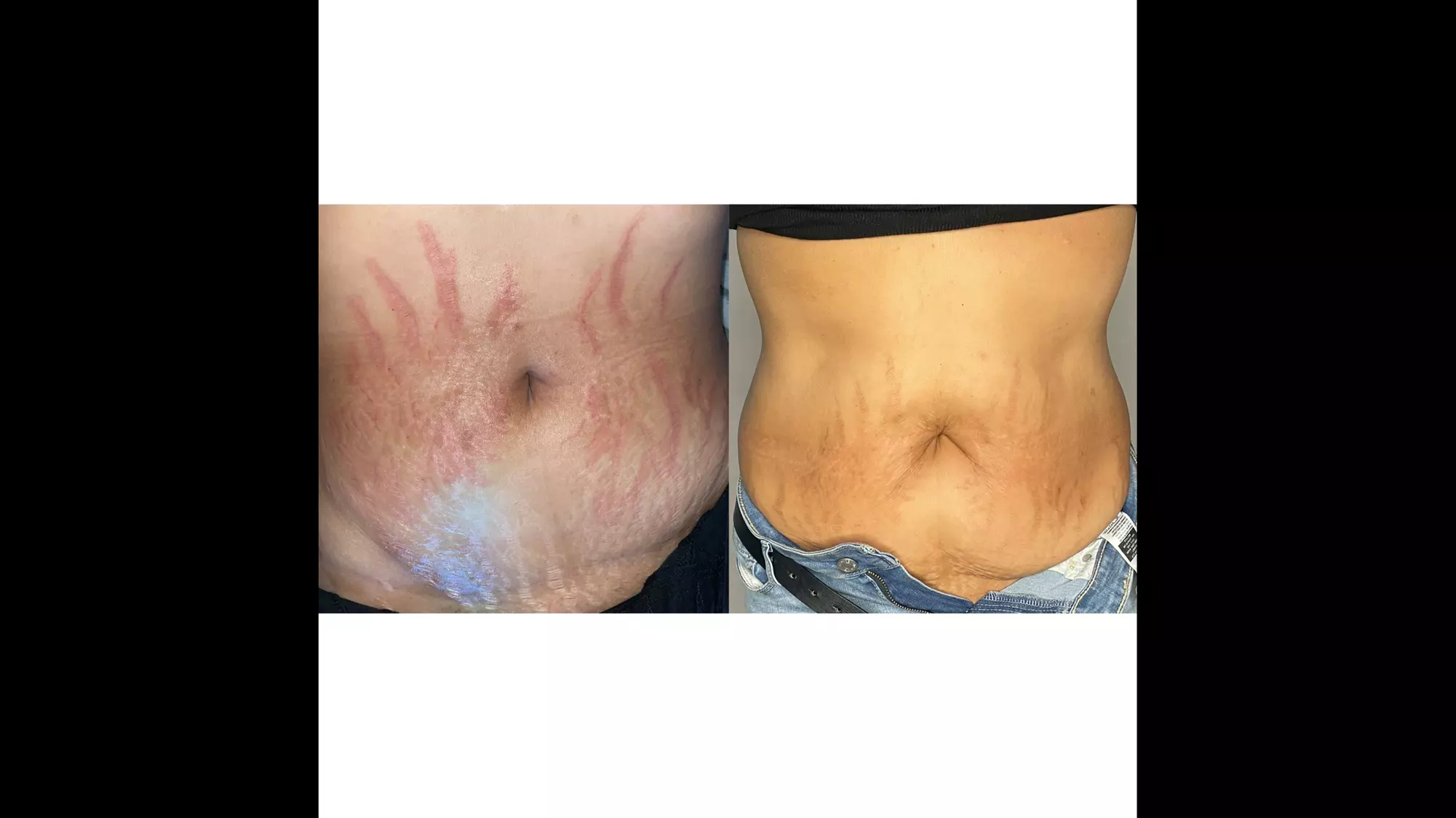 The Hourglass Method in Placentia | Groupon